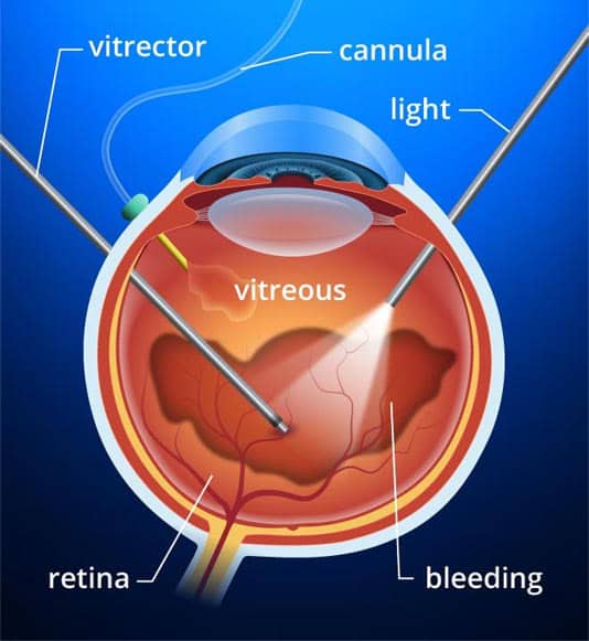 Vitreoretinal Surgery In Jalandhar Vitreo Retina Surgery Cost In Vitreoretinal Surgery In Jalandhar Vitreo Retina Surgery Cost In