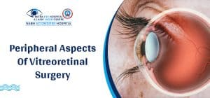 Guide on detail peripheral aspect of vitreoretinal surgery